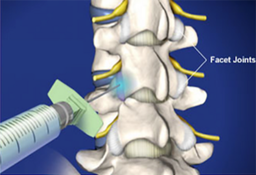 facet-join-injections - SOC Partner Relations Center