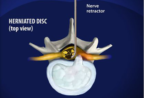 lumbar-micro-discectomy - SOC Partner Relations Center