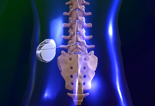 spinal-cord-stimulation-implants - SOC Partner Relations Center