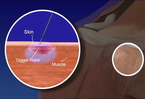 trigger-point-injection - SOC Partner Relations Center